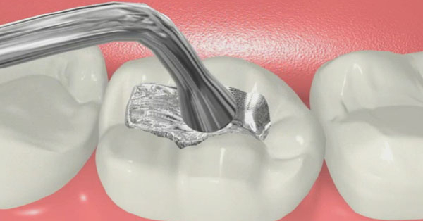 Composite vs. Amalgam Teeth Filling in San Francisco: Which is Better?